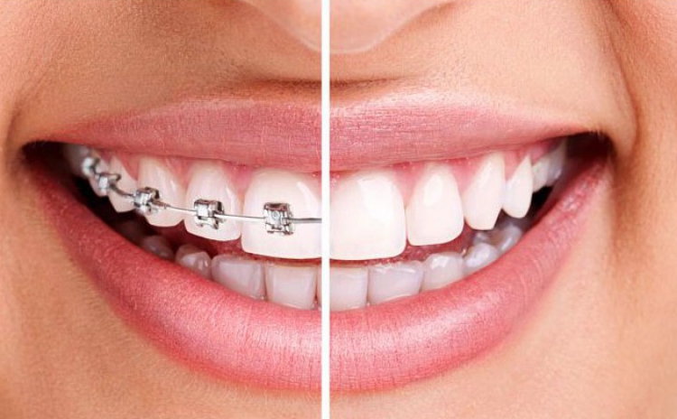 Ortodontie invizibila | Aparat dentar invizibil | Aparate dentare safir ...